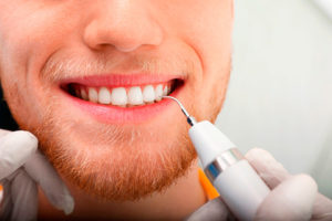 Sarro o cálculo dental :: ¿Qué es? ¿Sus efectos? y ¿Cómo eliminarlo?